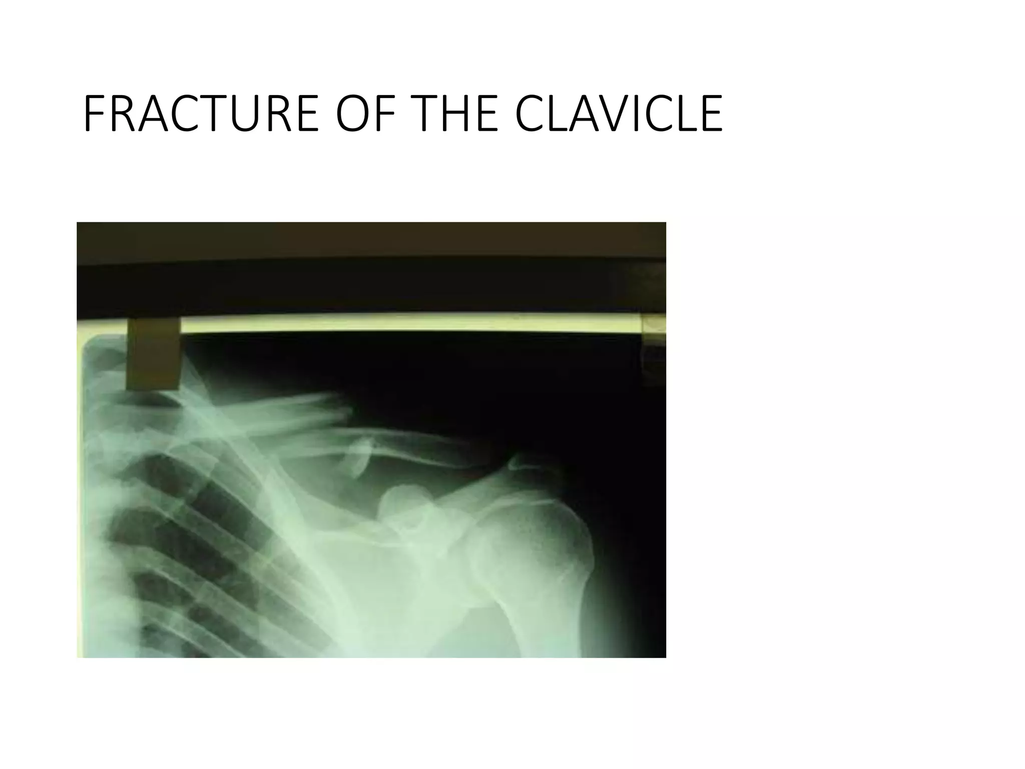 Shoulder Injuriespptx
