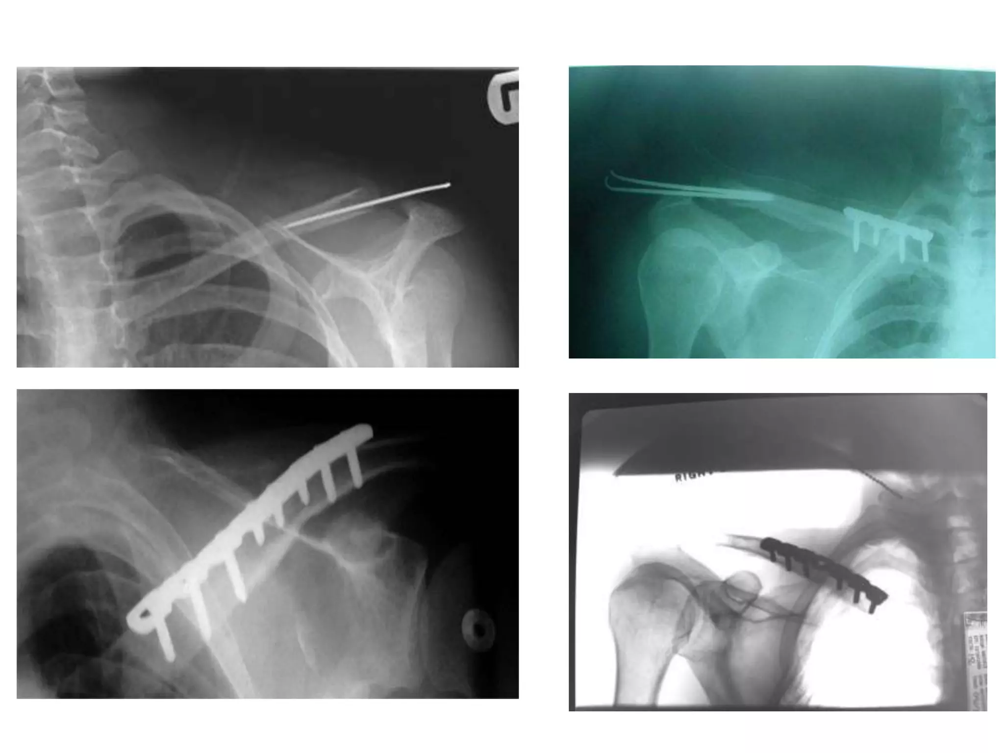 Shoulder Injuriespptx