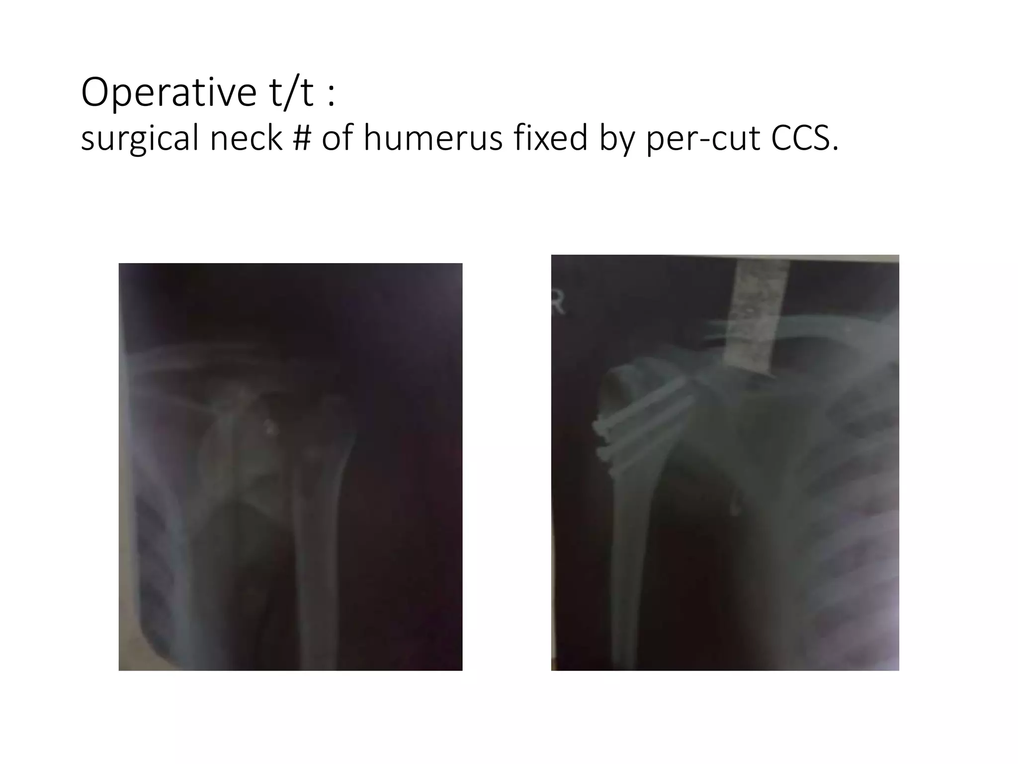 Shoulder Injuriespptx