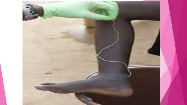Dracunculiasis