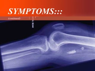 Dracunculiasis (Dracunculus medinensis) (guinea worm disease) | PPT