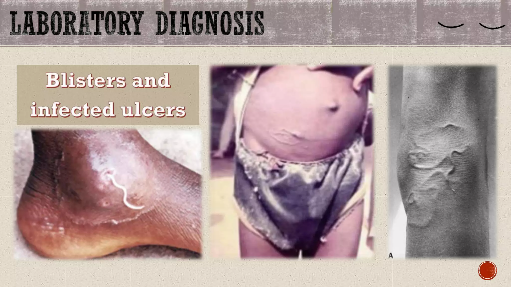 Dracunculus medinensis | PPTX