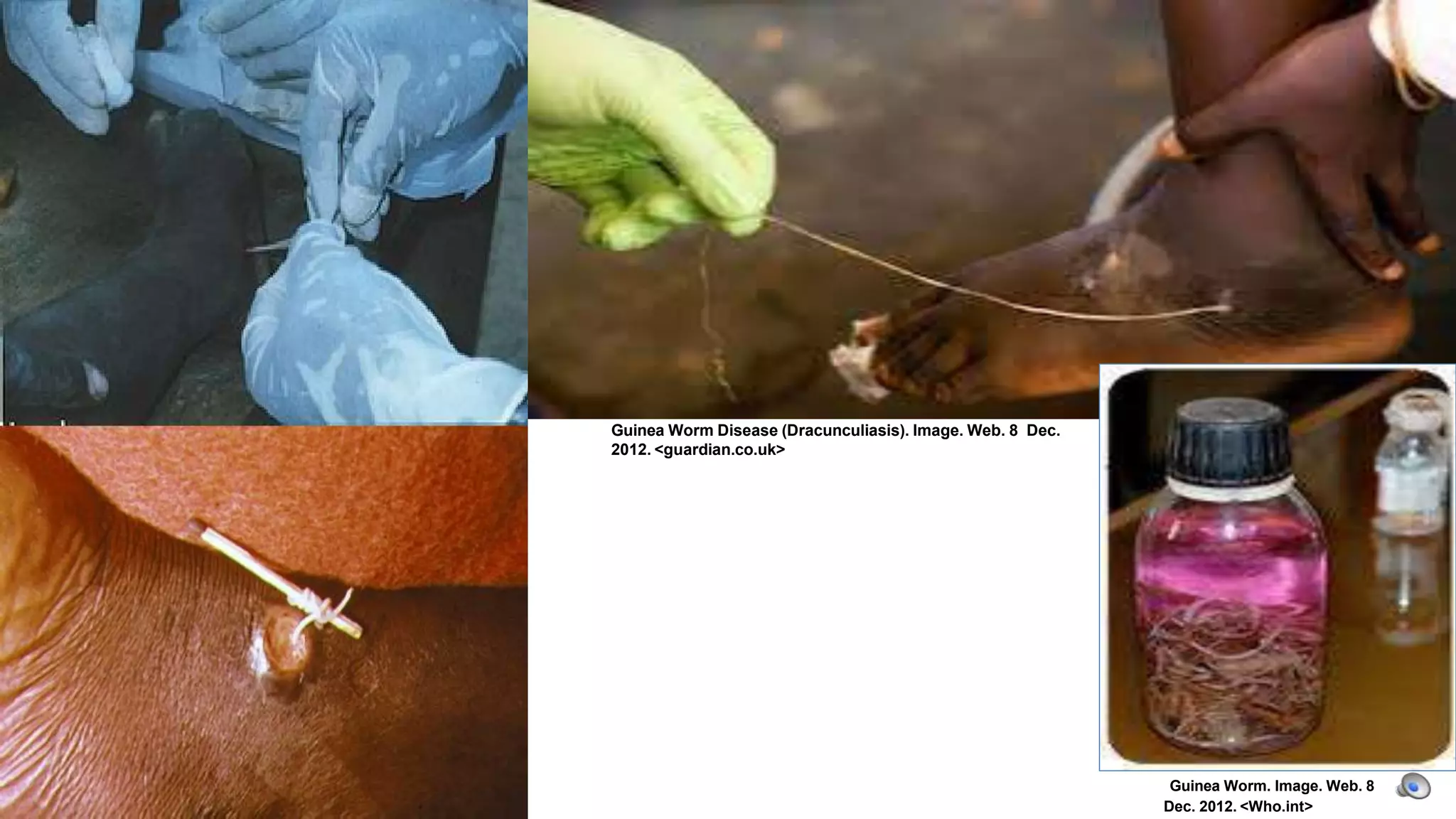 Dracunculus medinensis | PPTX