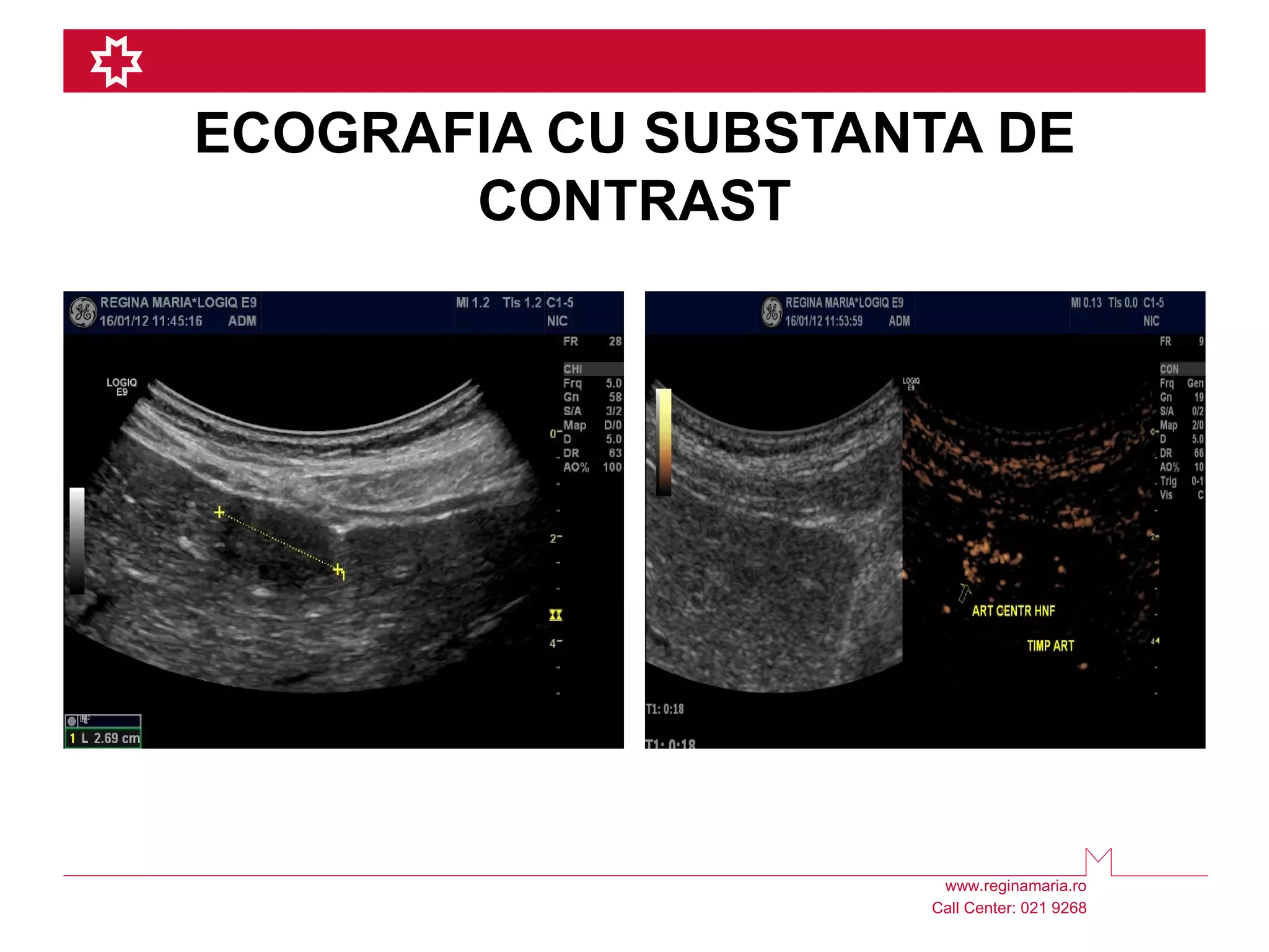 Ecografia cu substanta de contrast si elastografia | PPT