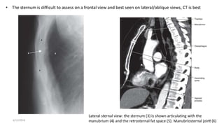 Diaphragm and chest wall anatomy with some clinical correlates | PPTX