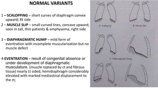 Diaphragm and chest wall anatomy with some clinical correlates | PPTX