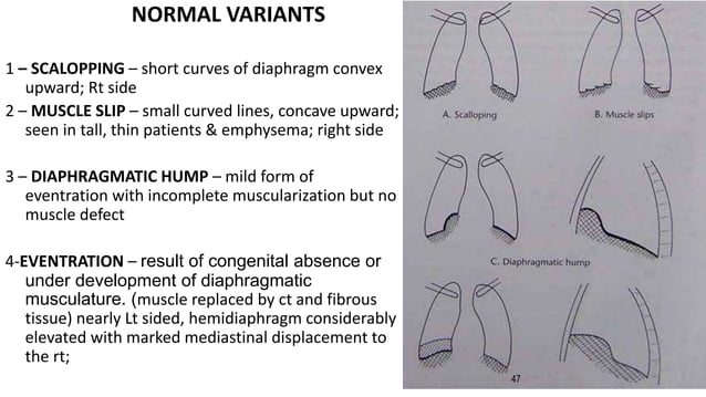 Diaphragm and chest wall anatomy with some clinical correlates | PPTX ...