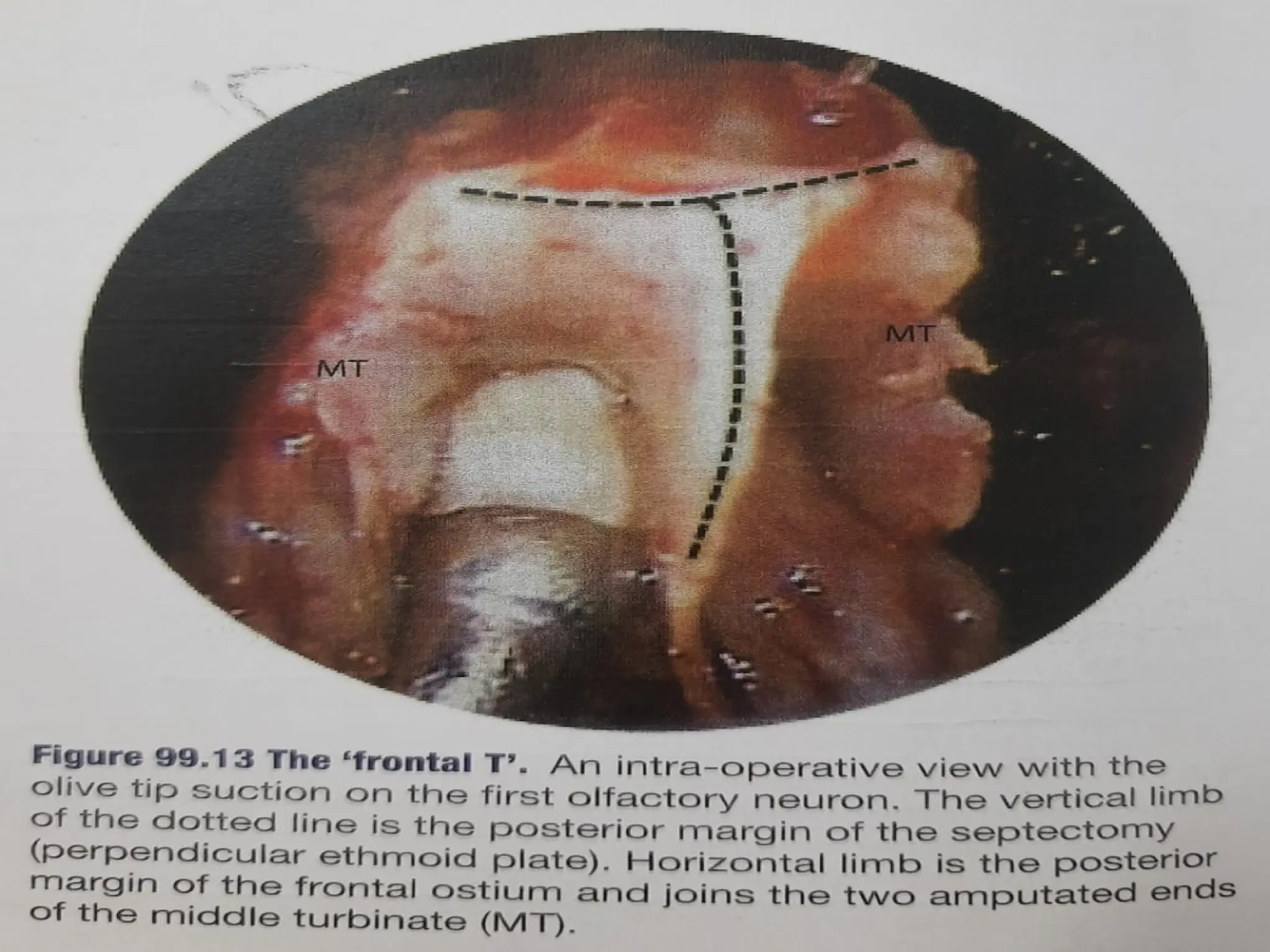 DRAF PROCEDURES FOR FRONTAnhgjgL SINUS.pptx