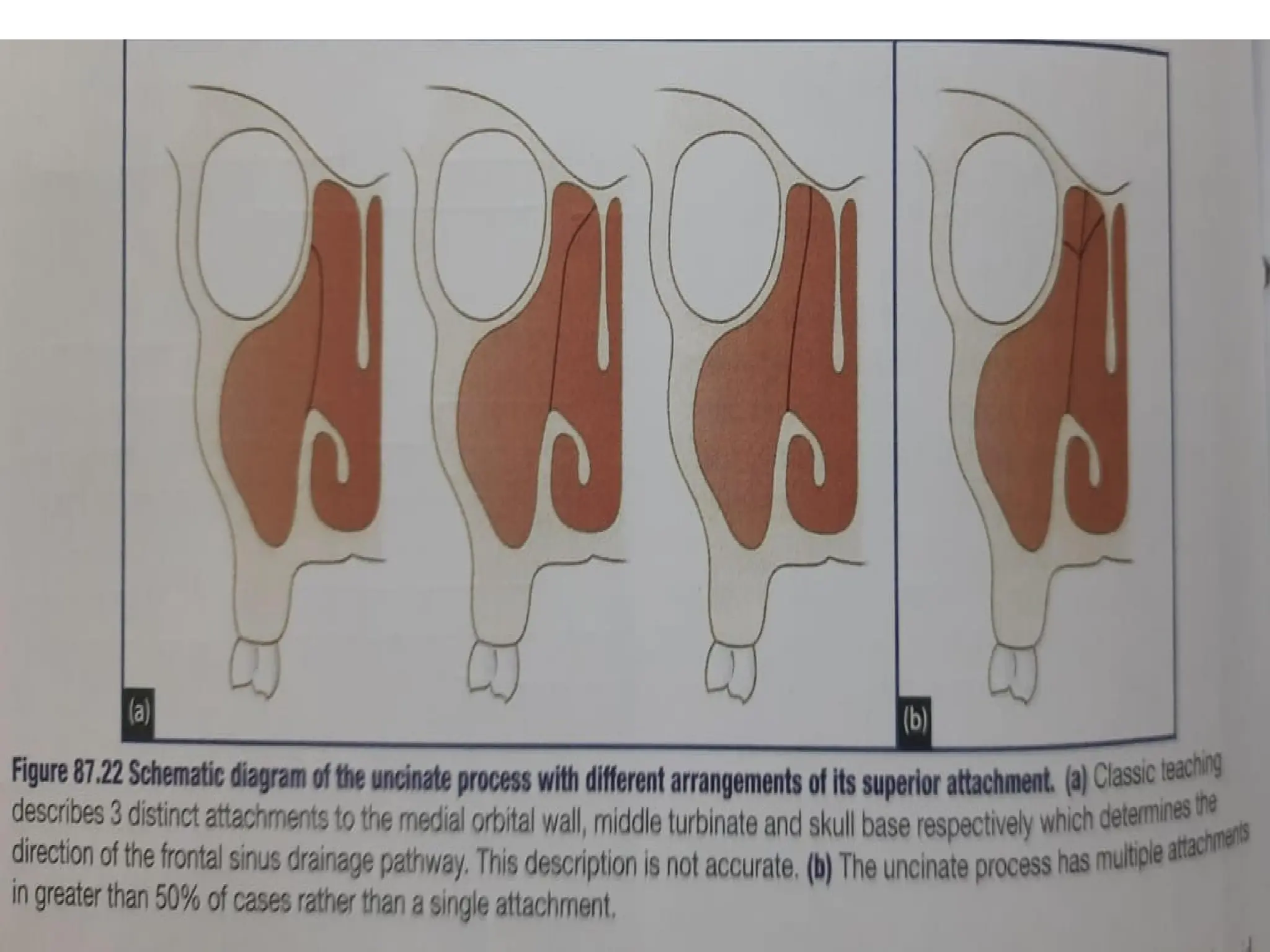 DRAF PROCEDURES FOR FRONTAnhgjgL SINUS.pptx