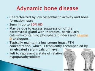 Adynamic Bone Disease