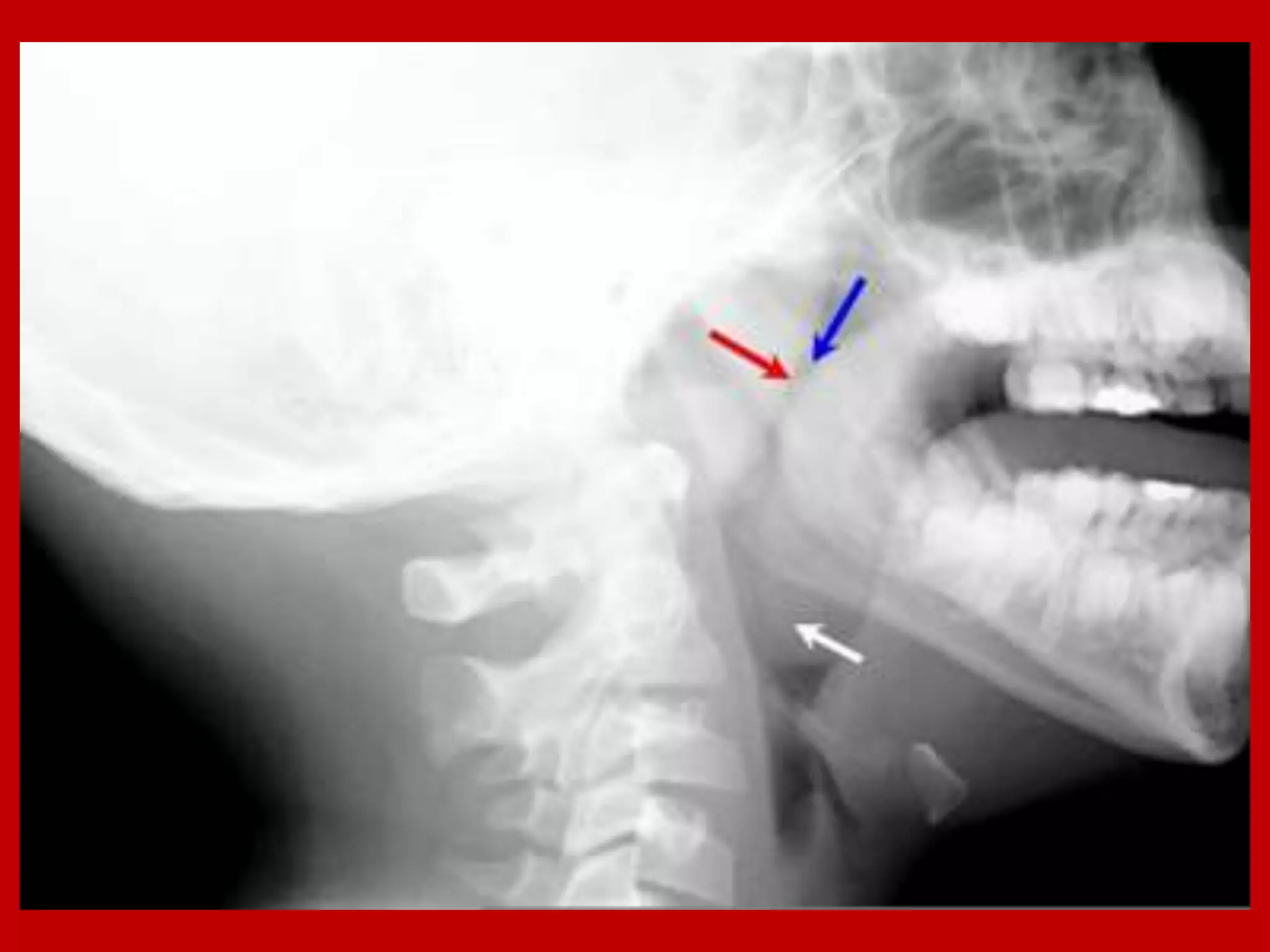 Dr ahmed esawy imaging of adeniod enlargment | PDF