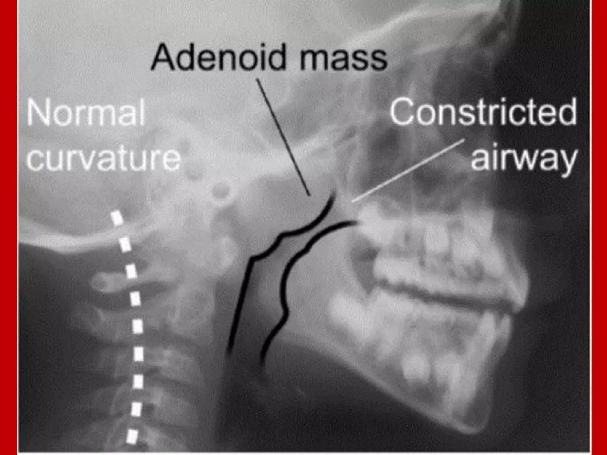Dr ahmed esawy imaging of adeniod enlargment | PDF