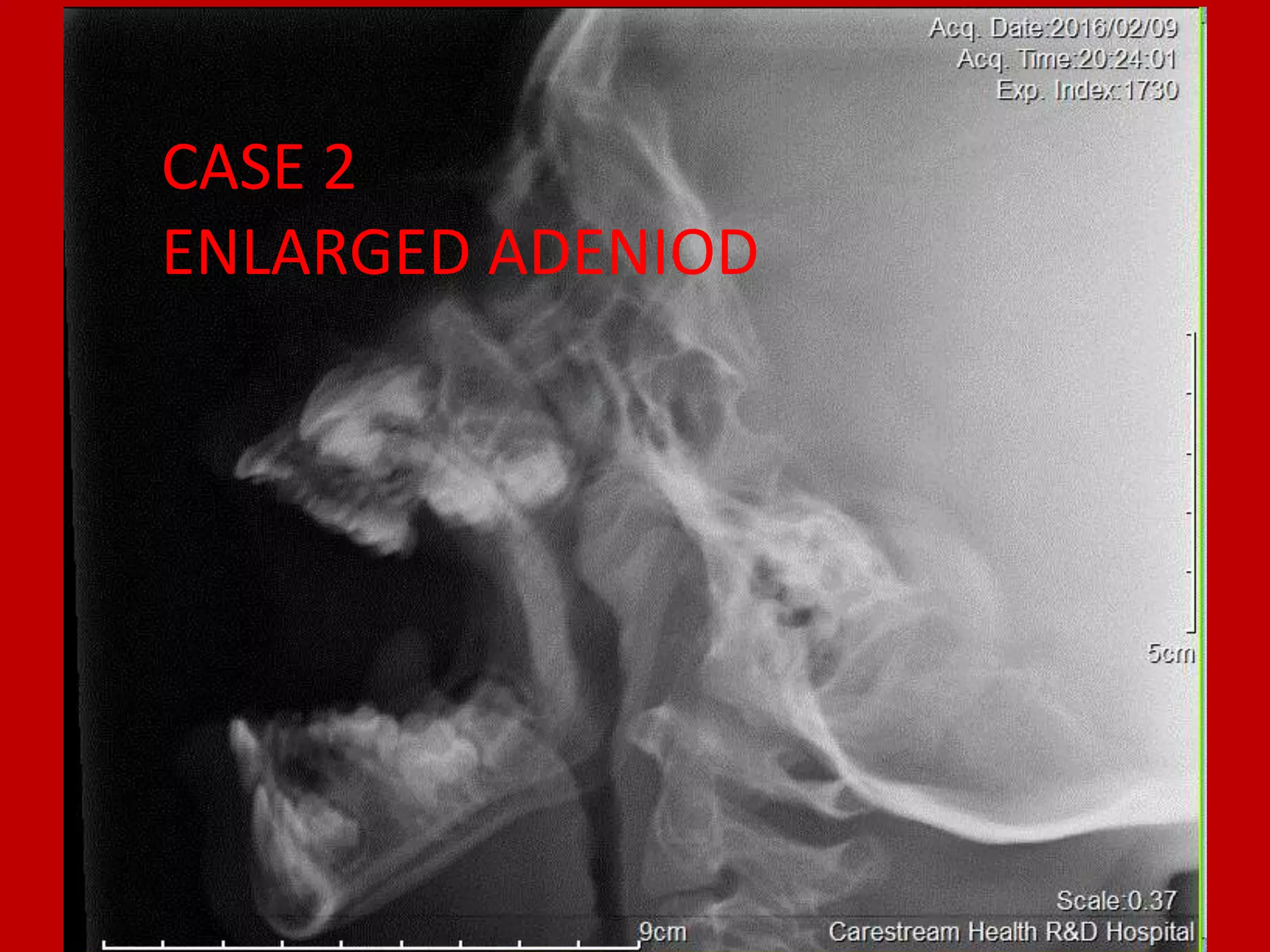 Dr ahmed esawy imaging of adeniod enlargment | PDF