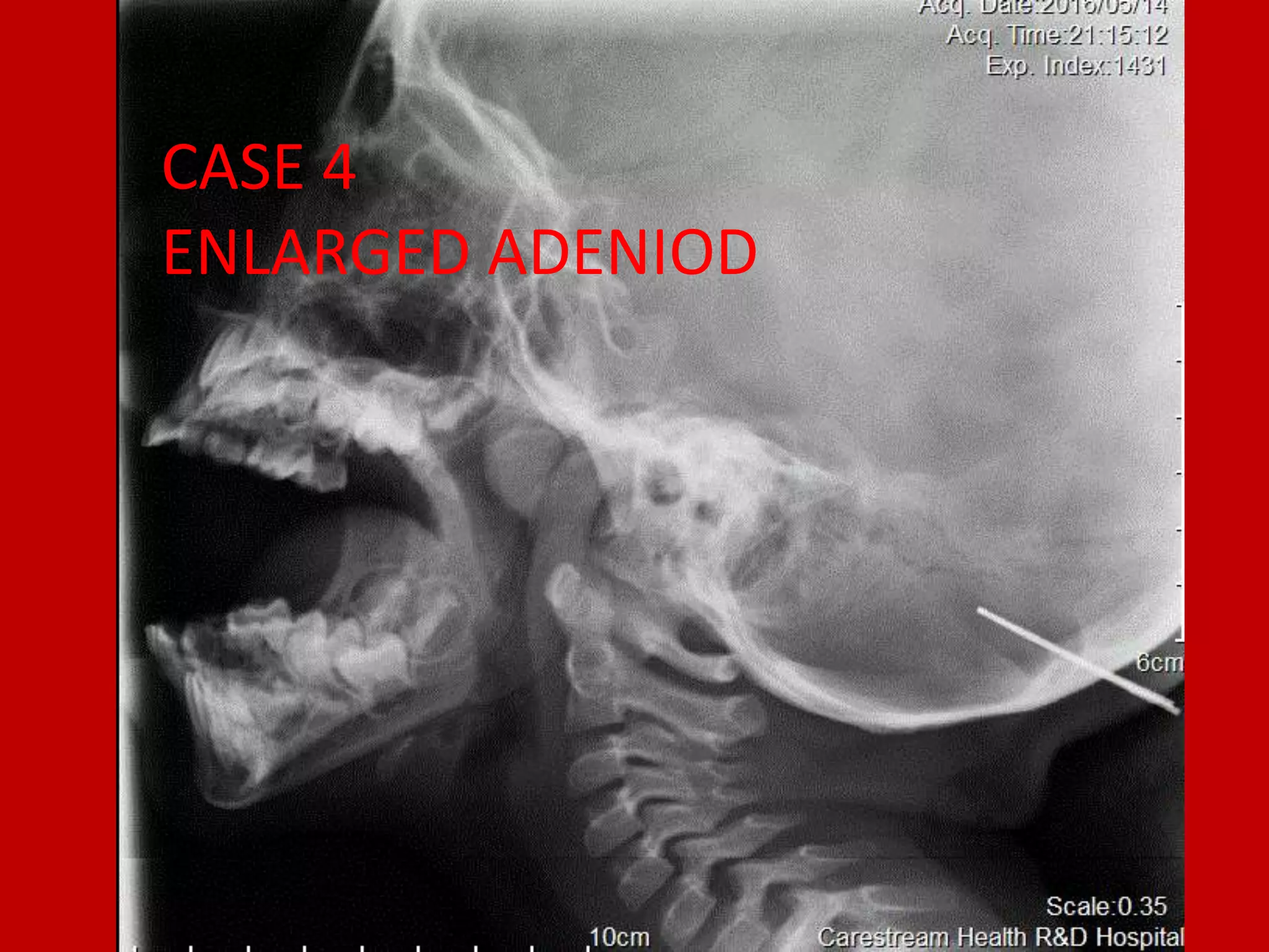 Dr ahmed esawy imaging of adeniod enlargment | PDF