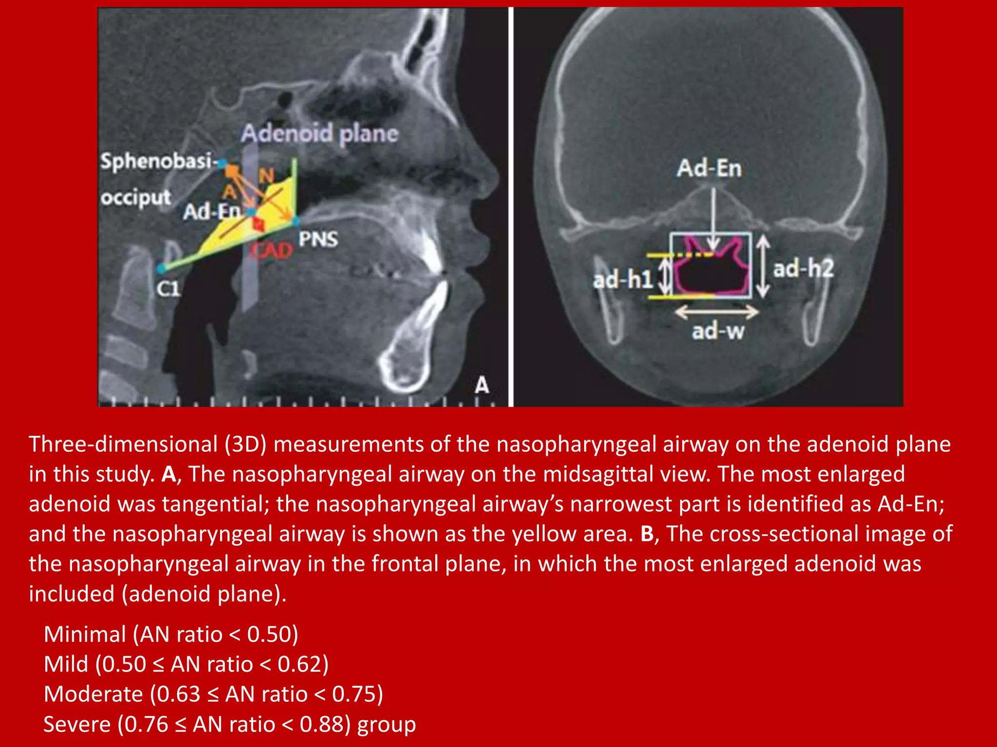 Dr ahmed esawy imaging of adeniod enlargment | PDF