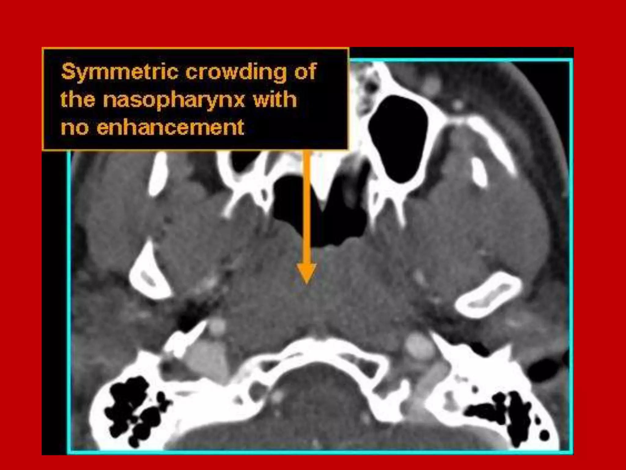 Dr ahmed esawy imaging of adeniod enlargment | PDF