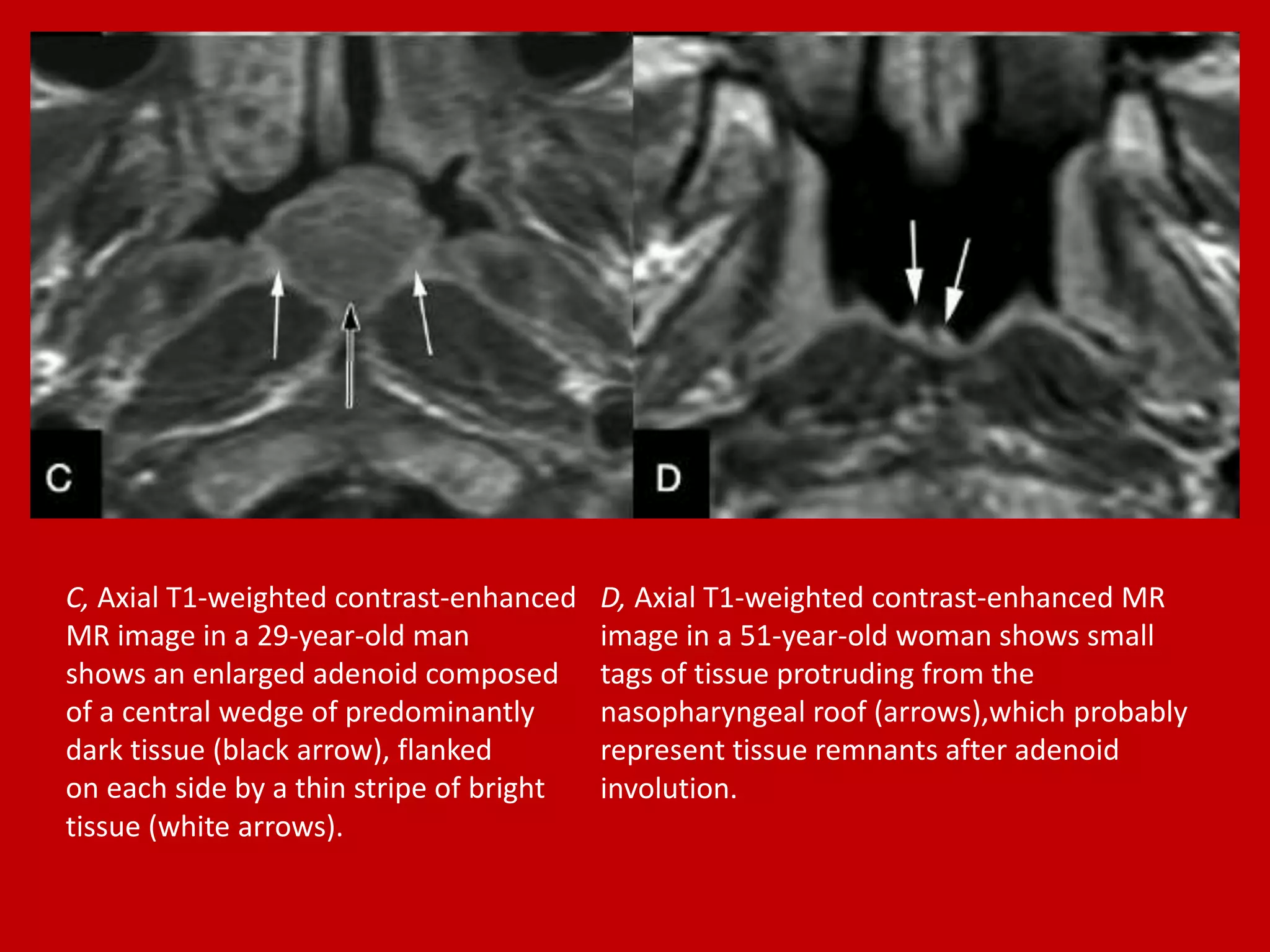 Dr ahmed esawy imaging of adeniod enlargment | PDF