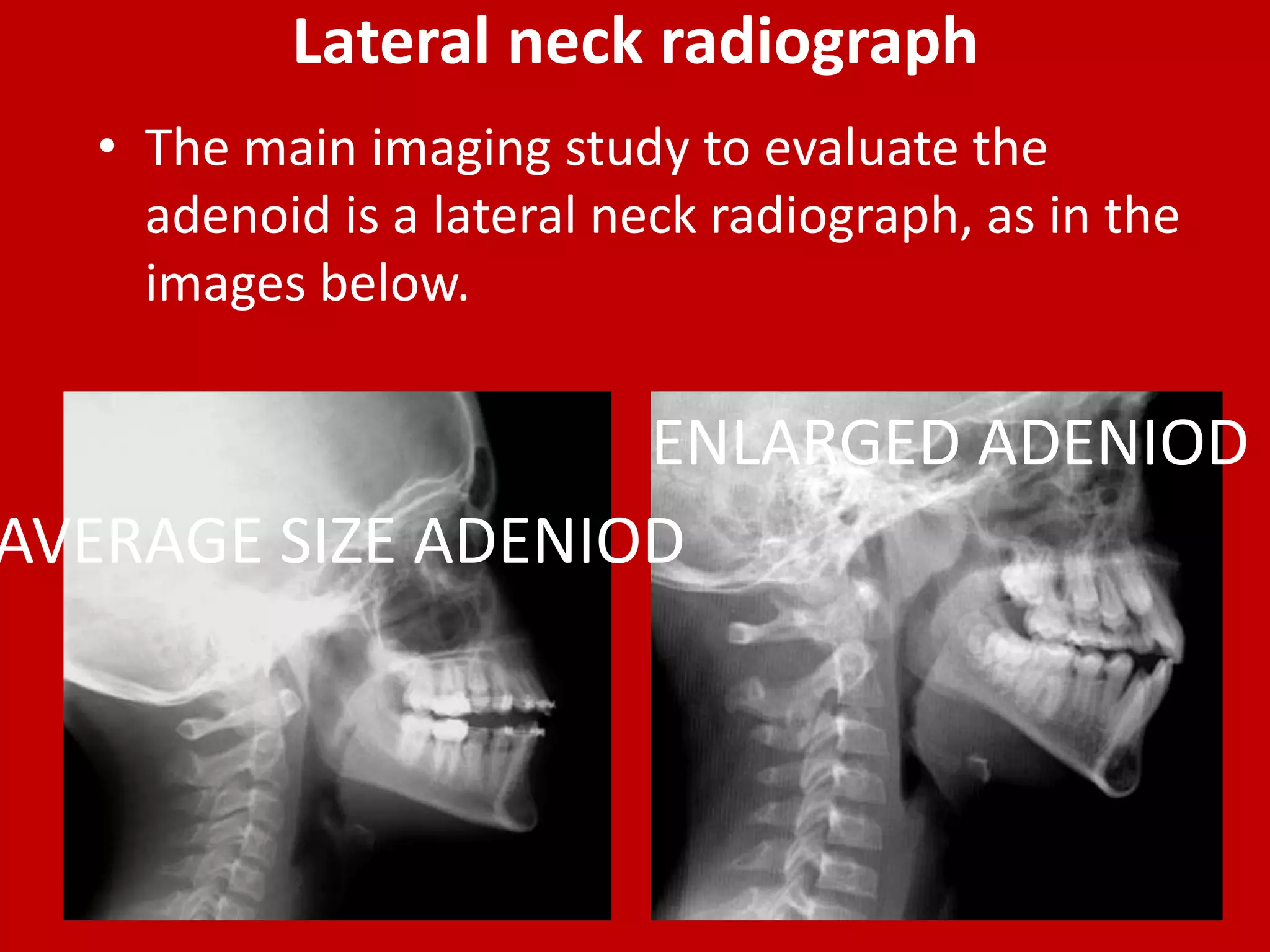 Dr ahmed esawy imaging of adeniod enlargment | PDF