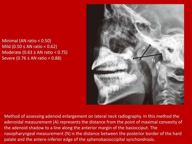 Dr ahmed esawy imaging of adeniod enlargment | PDF