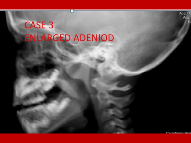Dr ahmed esawy imaging of adeniod enlargment | PDF