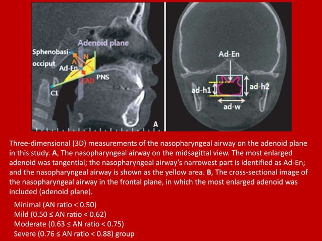 Dr ahmed esawy imaging of adeniod enlargment | PDF