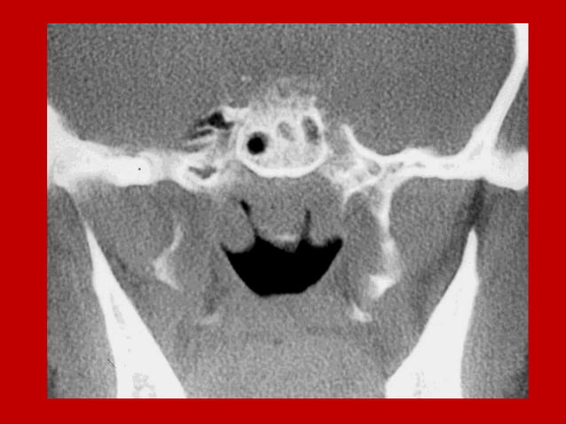 Dr ahmed esawy imaging of adeniod enlargment | PDF