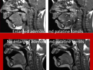 Dr ahmed esawy imaging of adeniod enlargment | PDF