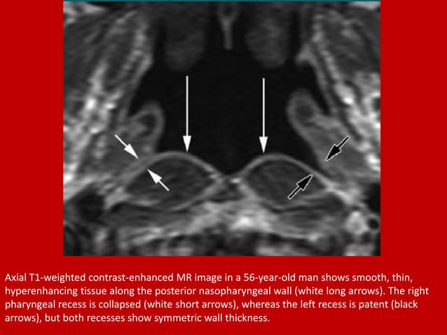Dr ahmed esawy imaging of adeniod enlargment | PDF