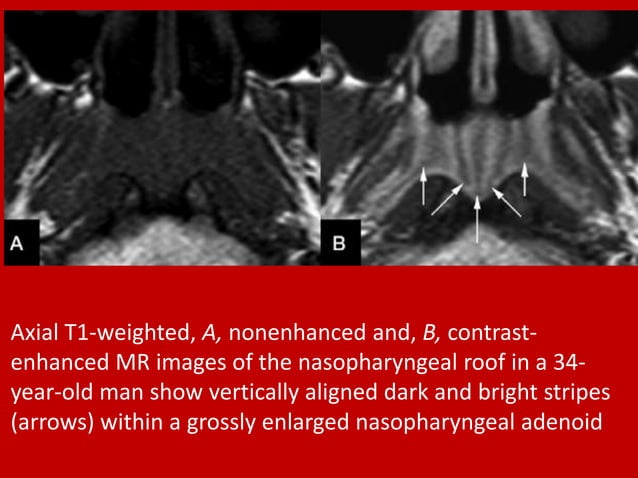 Dr ahmed esawy imaging of adeniod enlargment | PDF