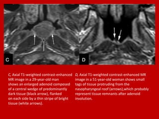 Dr ahmed esawy imaging of adeniod enlargment | PDF