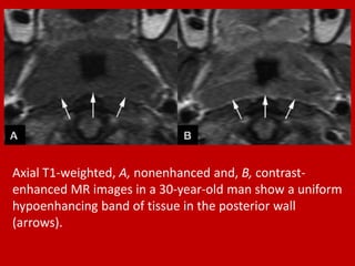 Dr ahmed esawy imaging of adeniod enlargment | PDF