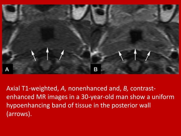 Dr ahmed esawy imaging of adeniod enlargment | PDF