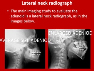 Adenoid X Ray