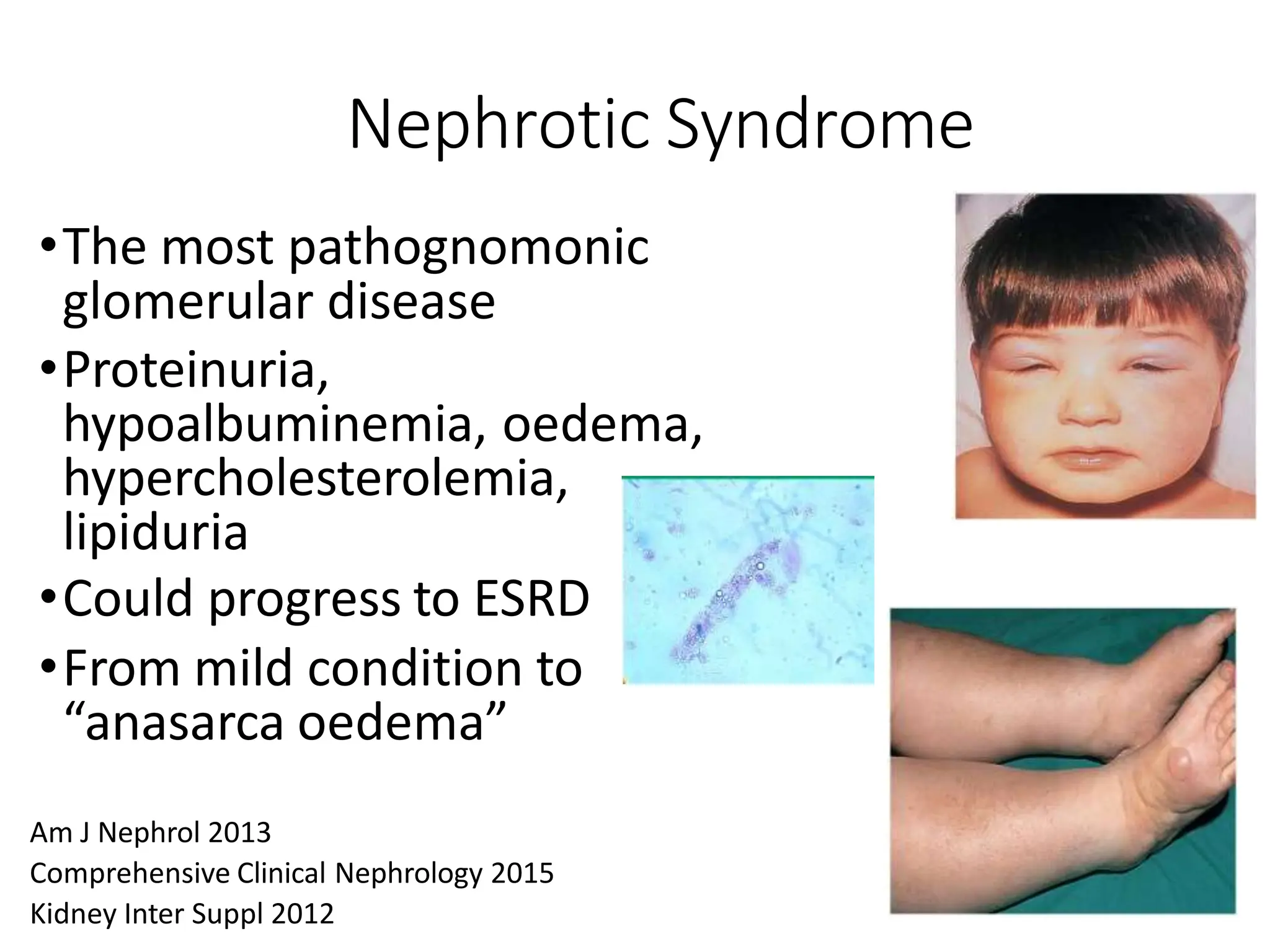 dr Aida Lydia - Practical Approach in CLomerular Disease (1).pptx ...