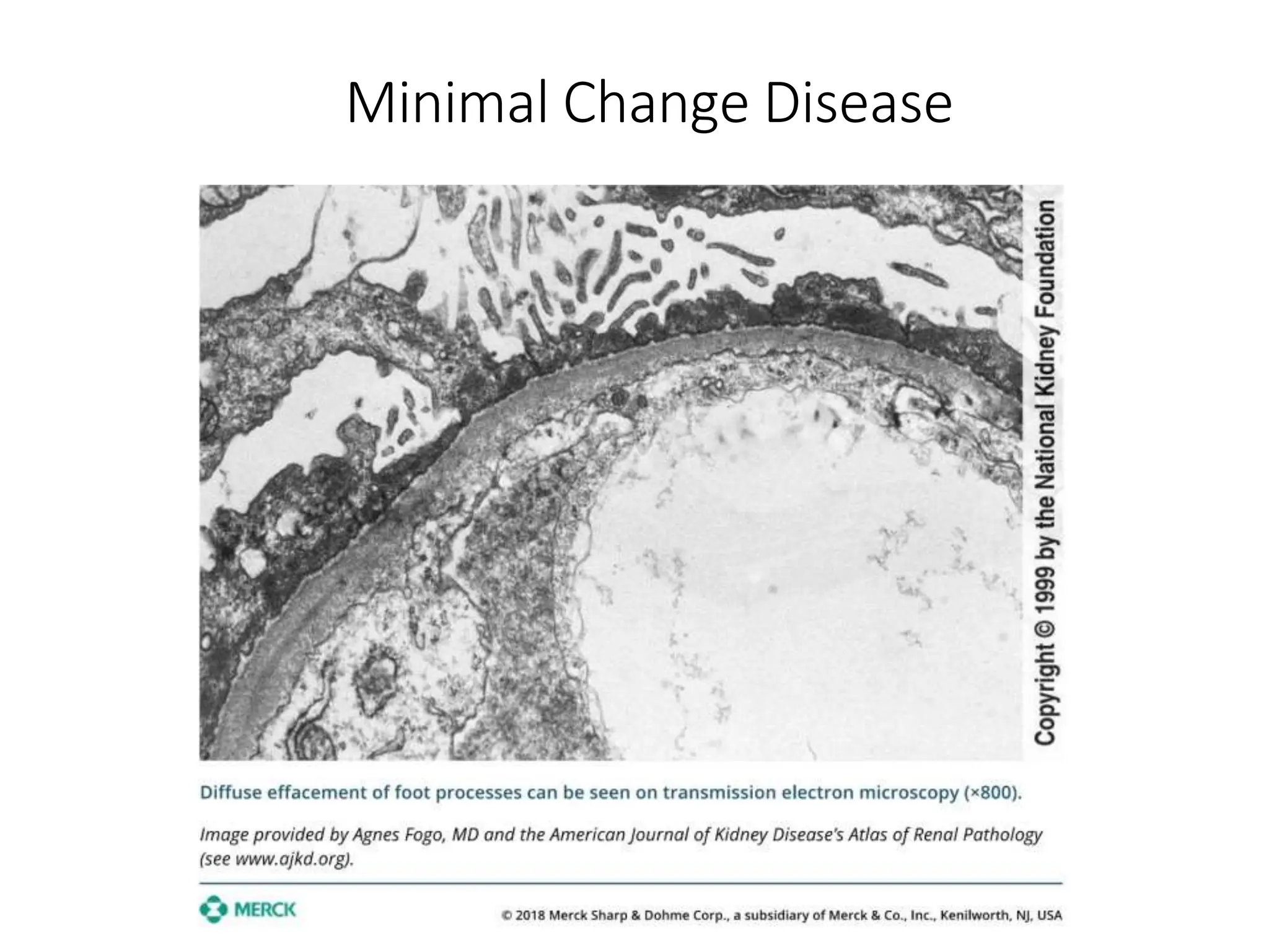 dr Aida Lydia - Practical Approach in CLomerular Disease (1).pptx ...