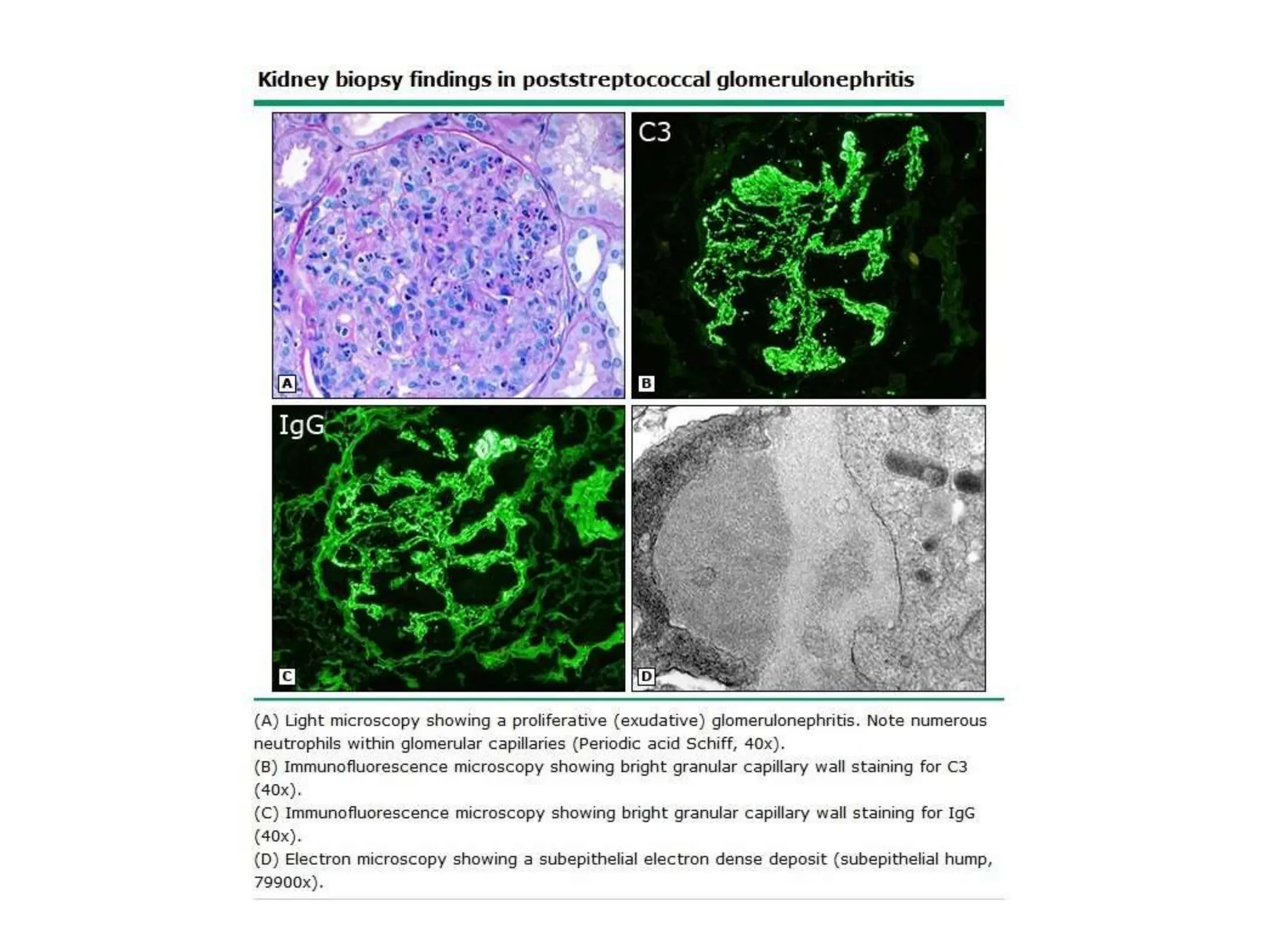 dr Aida Lydia - Practical Approach in CLomerular Disease (1).pptx ...
