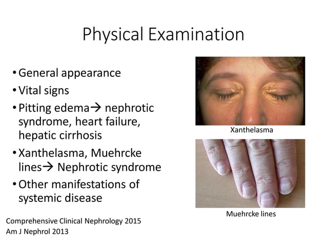 dr Aida Lydia - Practical Approach in CLomerular Disease (1).pptx