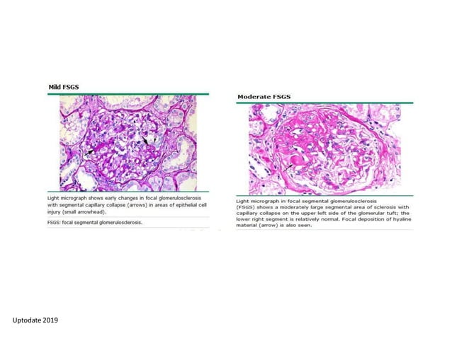dr Aida Lydia - Practical Approach in CLomerular Disease (1).pptx