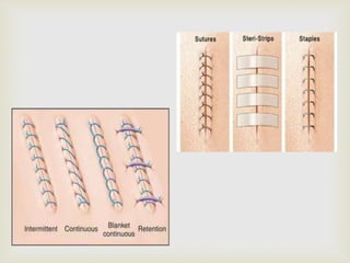 suturing and care of drainage | PPTX