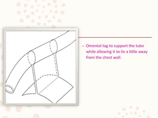 Drainage of pleural cavity | PPT