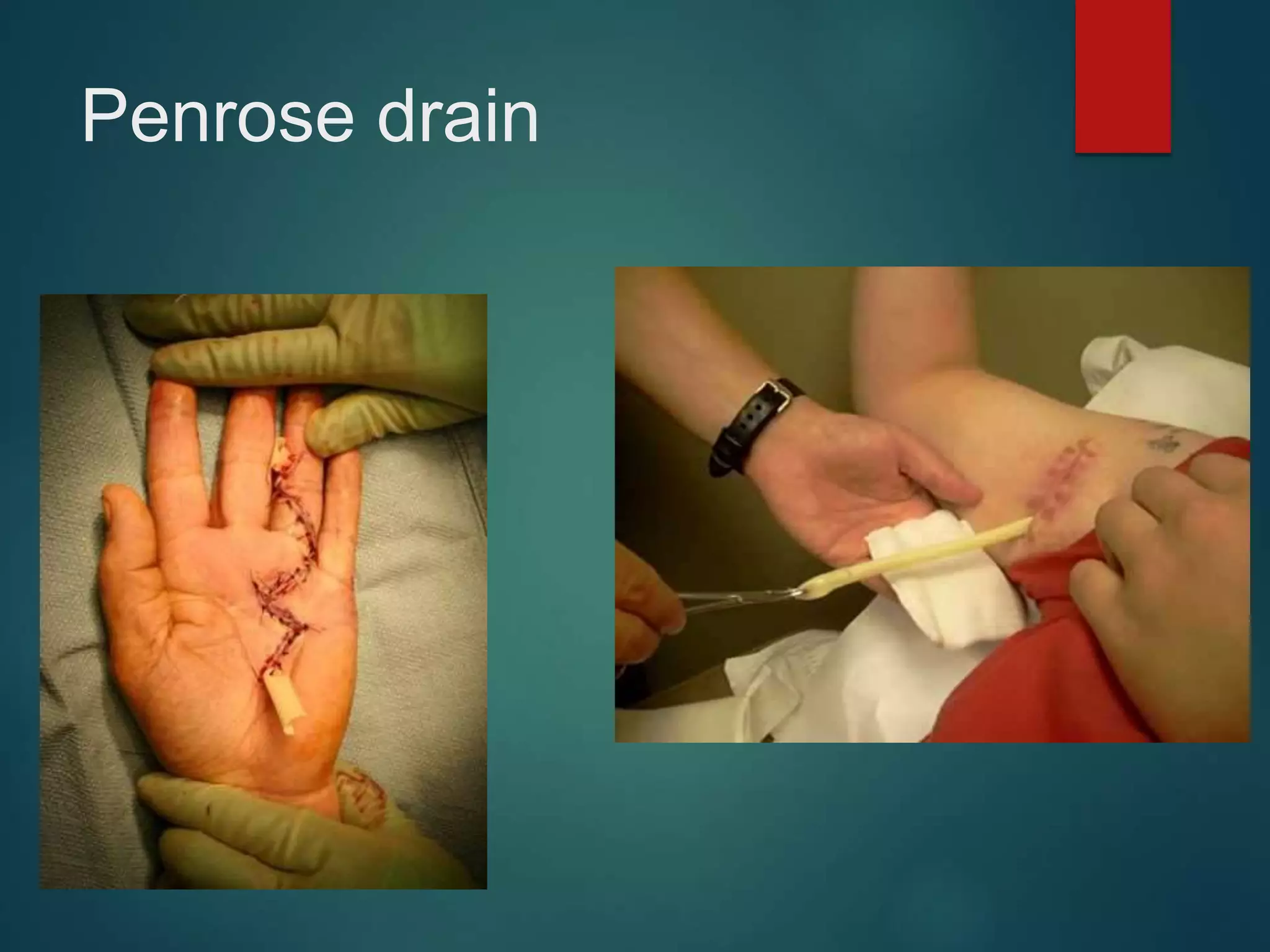 DRAINS AND DRAINAGE SYSTEMS IN SURGERY PPT - Corrected.ppt