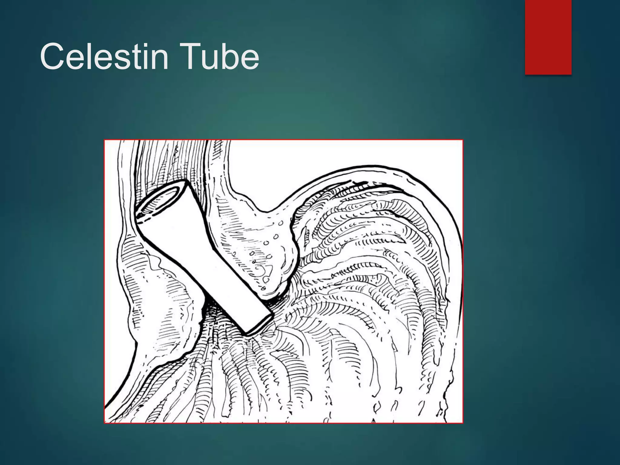 DRAINS AND DRAINAGE SYSTEMS IN SURGERY PPT - Corrected.ppt