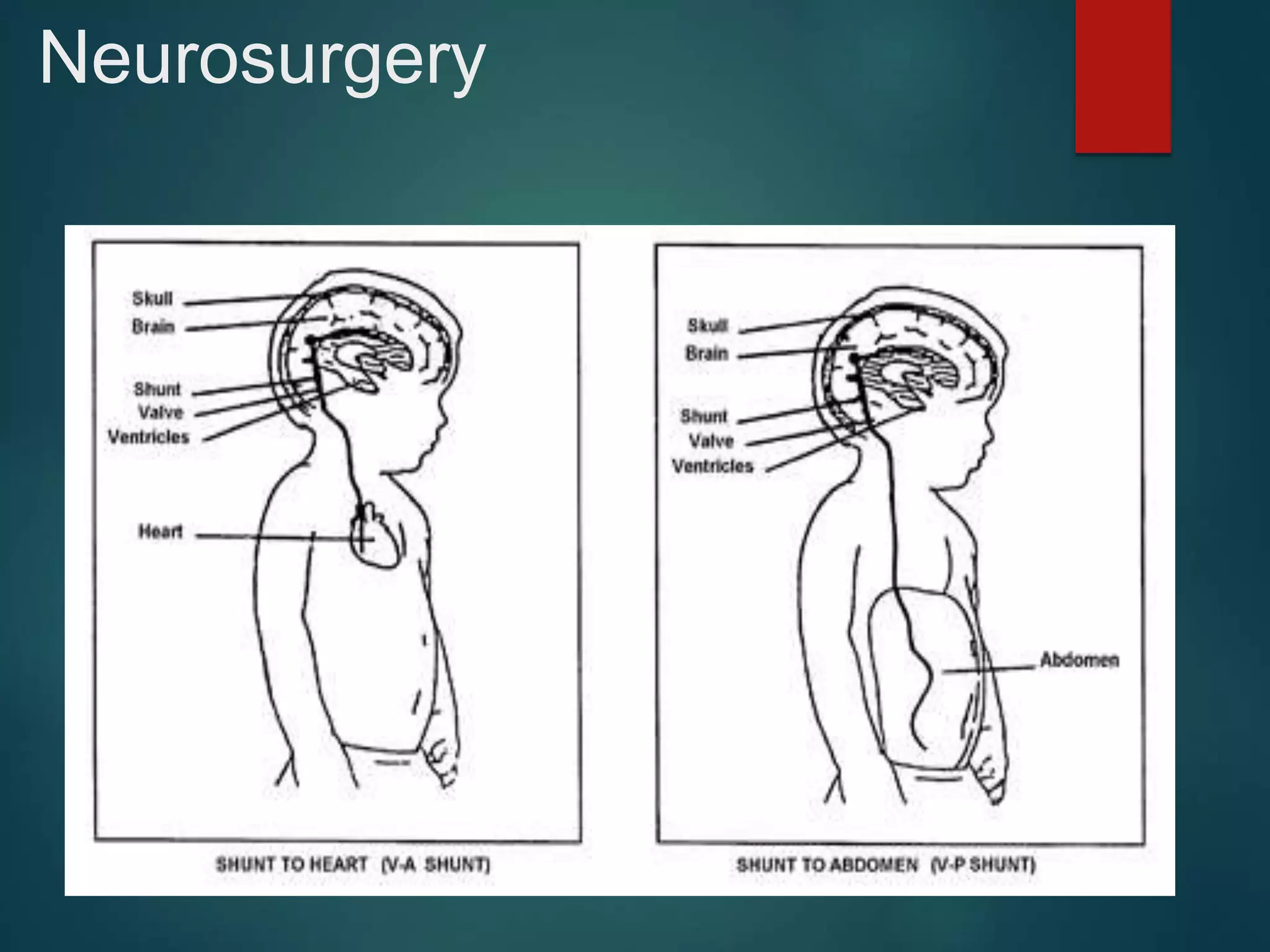 DRAINS AND DRAINAGE SYSTEMS IN SURGERY PPT - Corrected.ppt