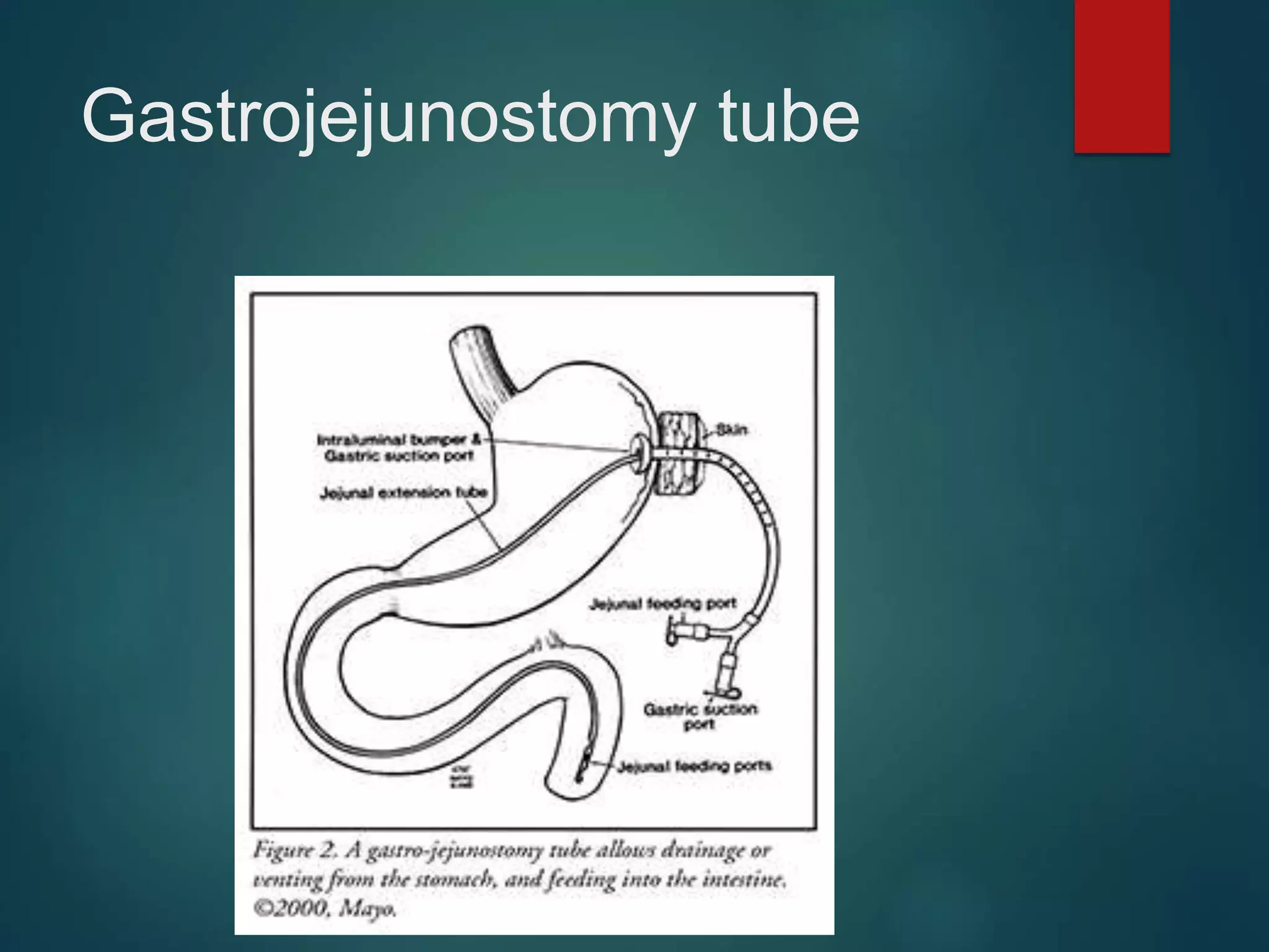 DRAINS AND DRAINAGE SYSTEMS IN SURGERY PPT - Corrected.ppt