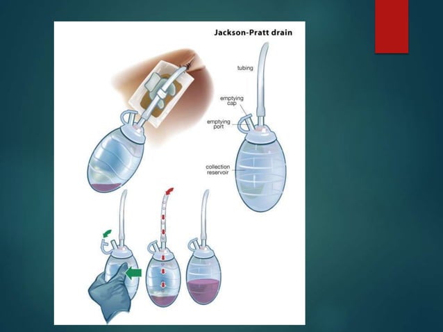 DRAINS AND DRAINAGE SYSTEMS IN SURGERY PPT - Corrected.ppt