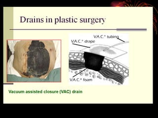 DRAINS IN SURGERY surgery lecture for medical students.ppt