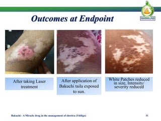BAKUCHI A MIRACLE DRUG IN VITILIGO BY DR AJITH | PPTX
