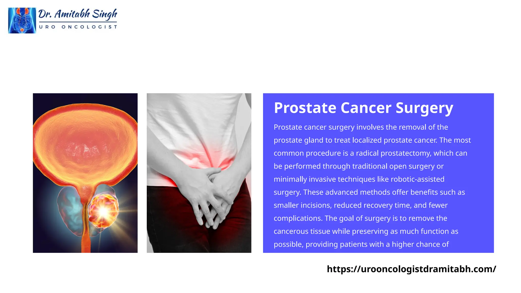 Prostate Cancer Surgery: Procedures, Benefits, and What to Expect" | PPT