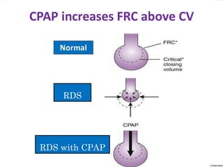 Non-invasive Ventilation (CPAP) in Newborns | PPT