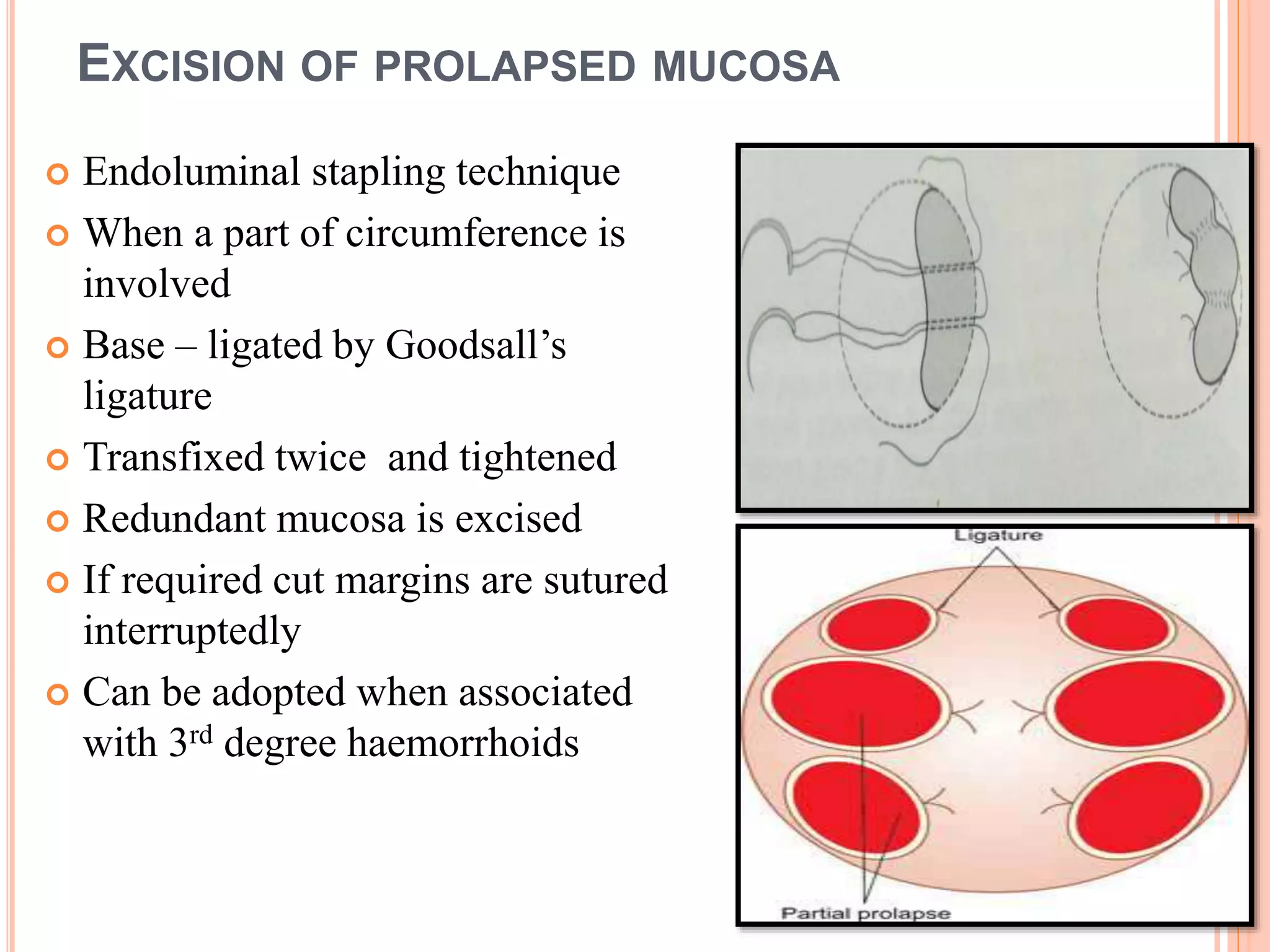 Dr Anisha Rectal prolapse.pptx